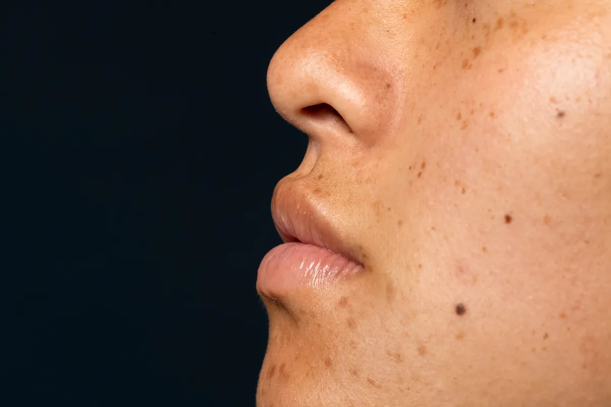 Small Black Specks On Skin: Amazing Guide - Gold City