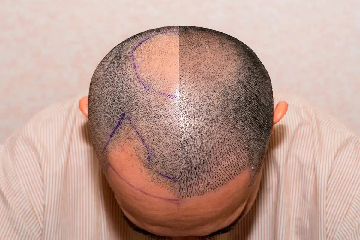 Hair Transplant After 20 Years: Best Info - Gold City
